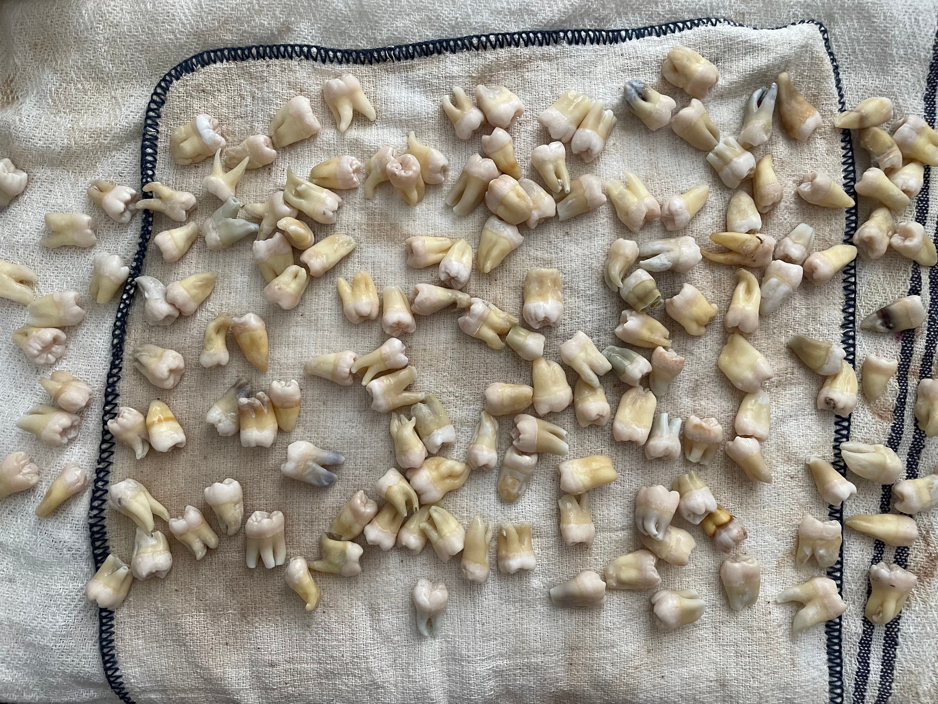 One Adult Human Tooth - Extracted by a Dentist - Used in a Recent ...