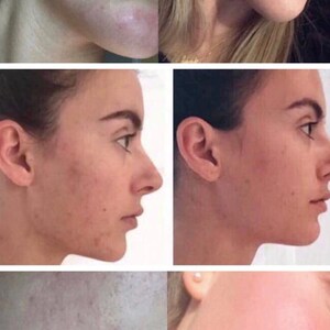 Nu Skin 180 AHA Facial Peel and Neutralizer at Home Chemical - Etsy