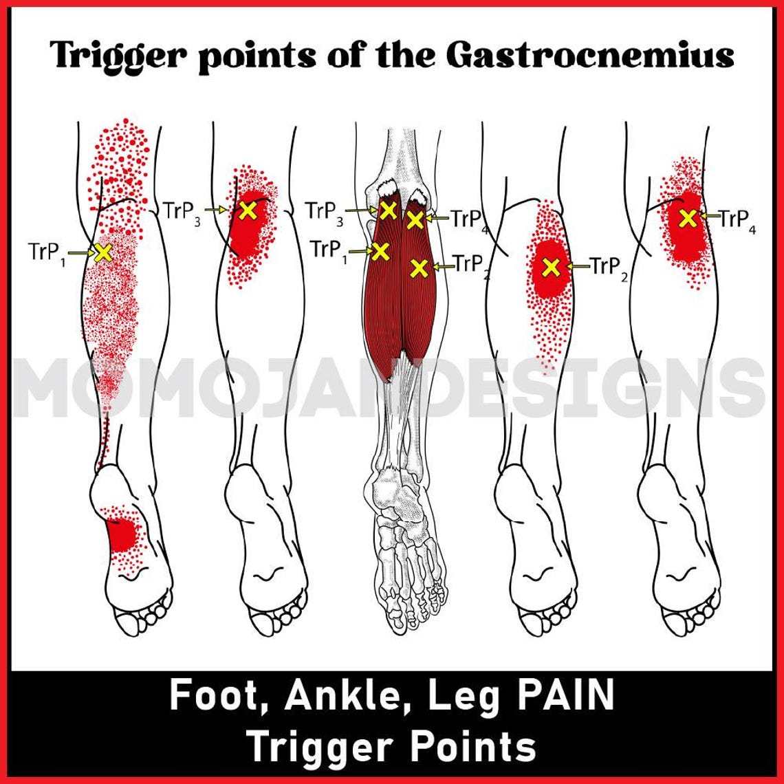 Foot Ankle Leg Pain Trigger Points Chart: Muscle Anatomy Poster ...