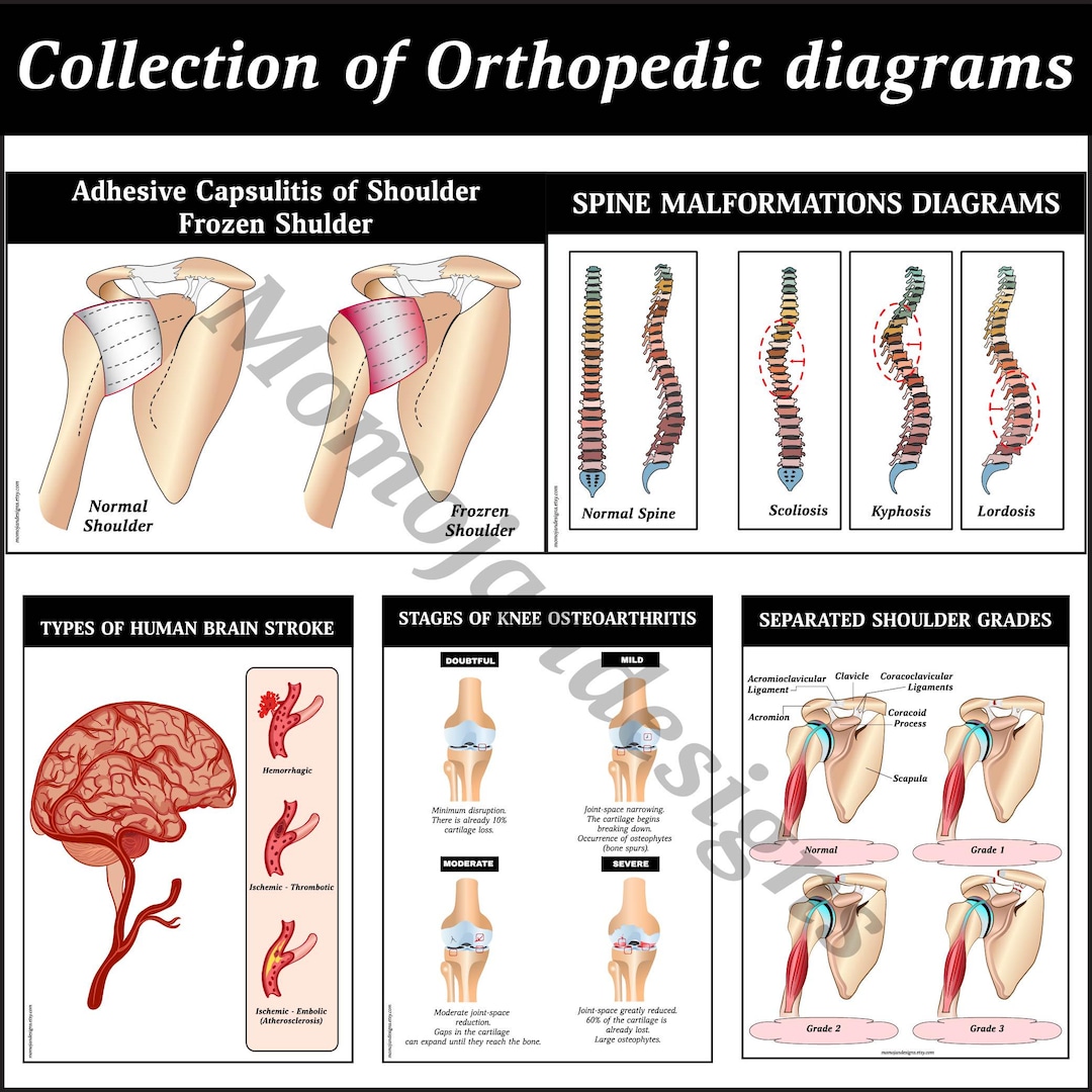 Orthopedic Anatomy Diagrams Poster Set| Medical Educational Charts ...