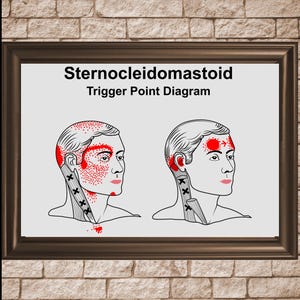 Head & Neck Trigger Point Charts: Muscle Pain Relief Diagrams (PDF) - Etsy