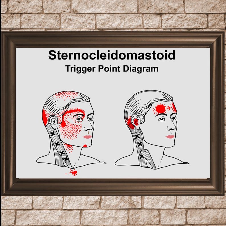 A Collection of Trigger Point Charts Head & Neck Muscle Pain Relief ...