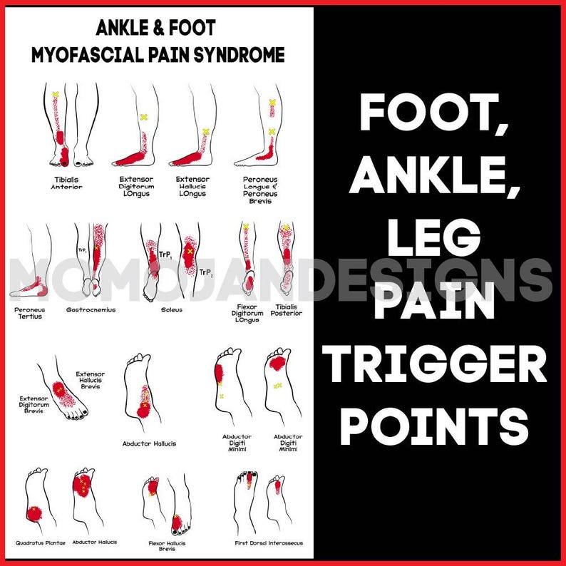 Foot Ankle Leg Pain Trigger Points Chart: Muscle Anatomy Poster ...