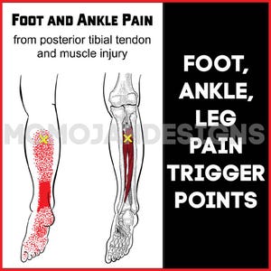 Foot Ankle Leg Pain Trigger Points Chart: Muscle Anatomy Poster ...