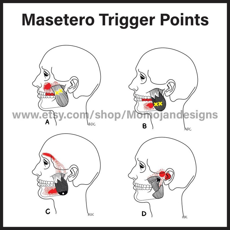 Head & Neck Trigger Point Charts: Muscle Pain Relief Diagrams (PDF) - Etsy