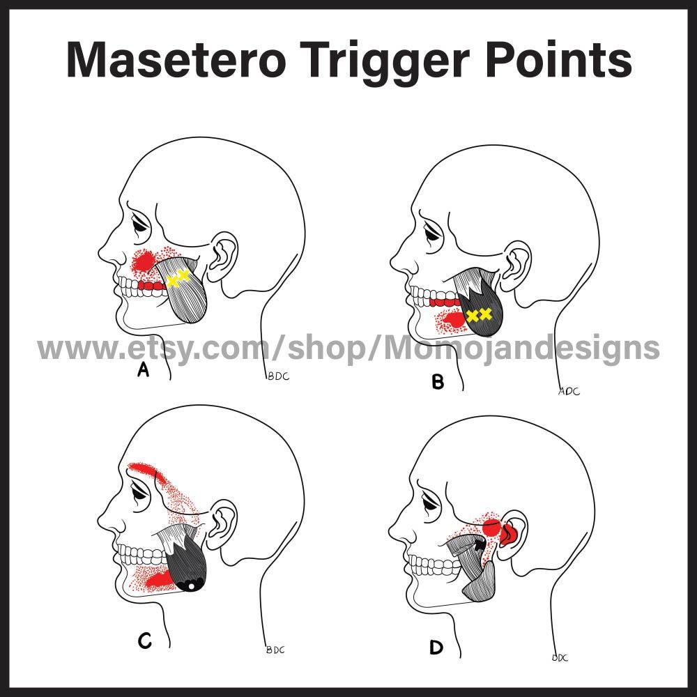 A Collection of Trigger Point Charts Head & Neck Muscle Pain Relief ...