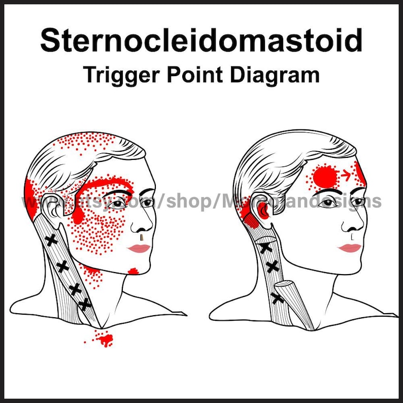 Head & Neck Trigger Point Charts: Muscle Pain Relief Diagrams (PDF) - Etsy