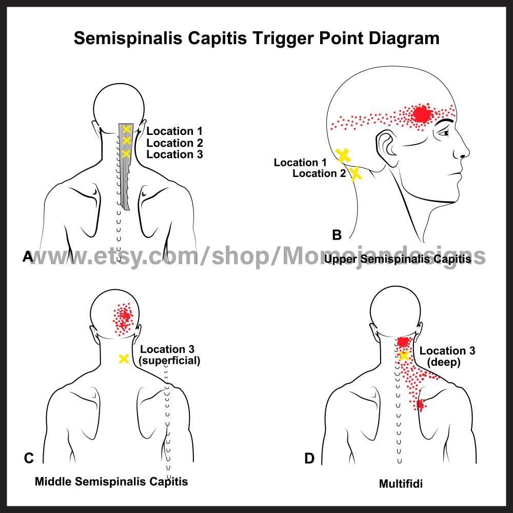 A Collection of Trigger Point Charts Head & Neck Muscle Pain Relief ...