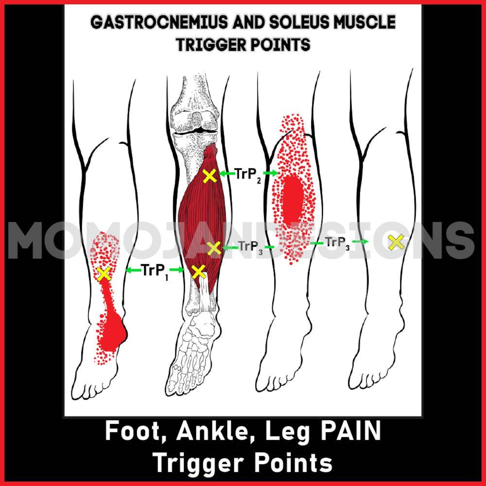 Foot Ankle Leg Pain Trigger Points Chart: Muscle Anatomy Poster ...