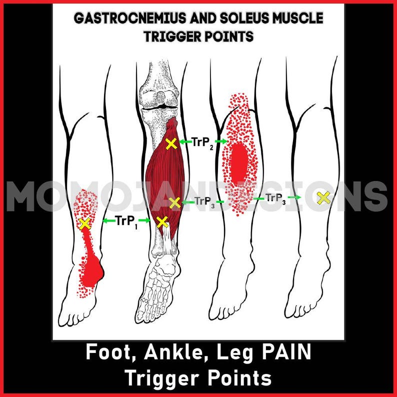 Foot Ankle Leg Pain Trigger Points Chart: Muscle Anatomy Poster ...