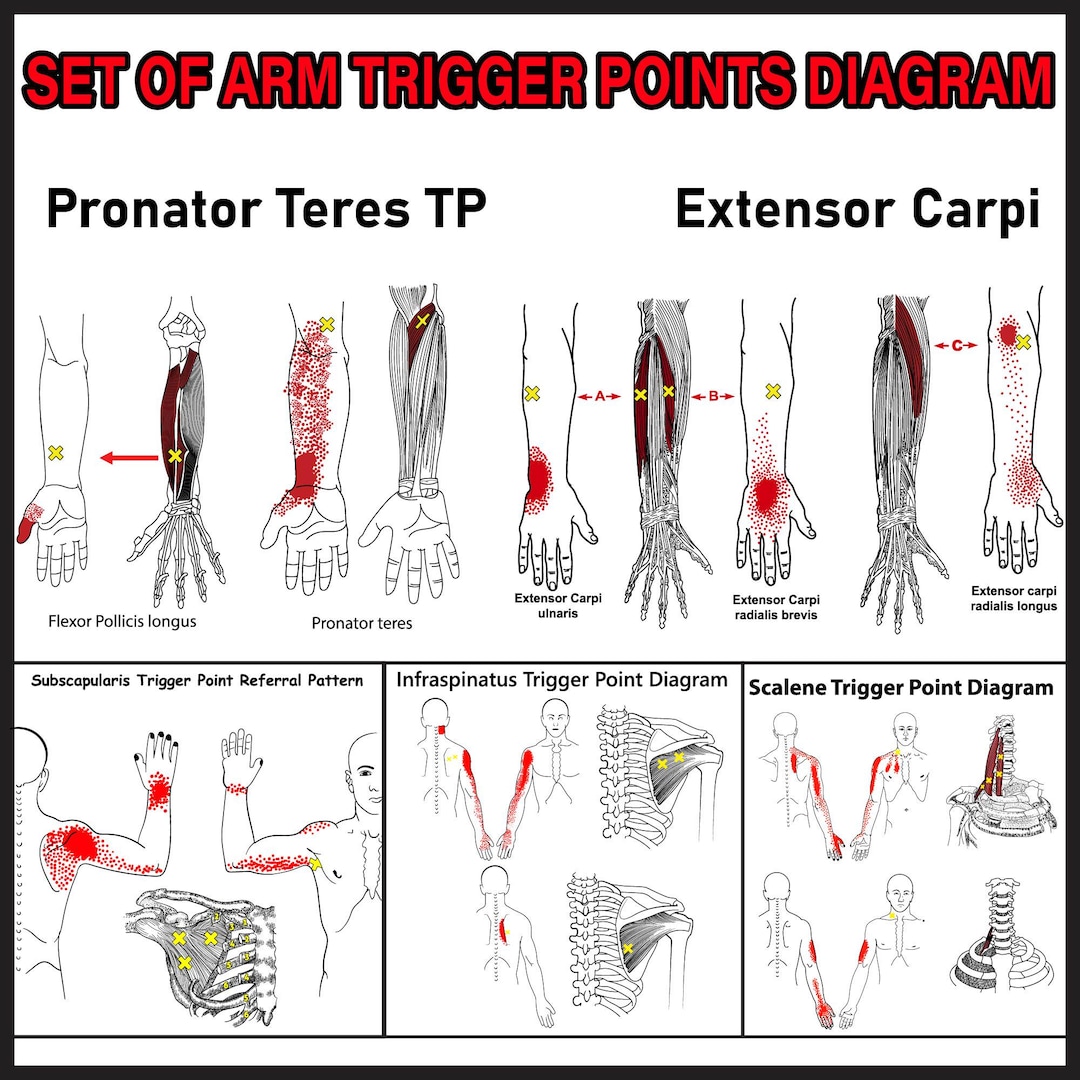 Arm Pain Trigger Points Diagram Set, Muscle Anatomy Chart, Physical ...