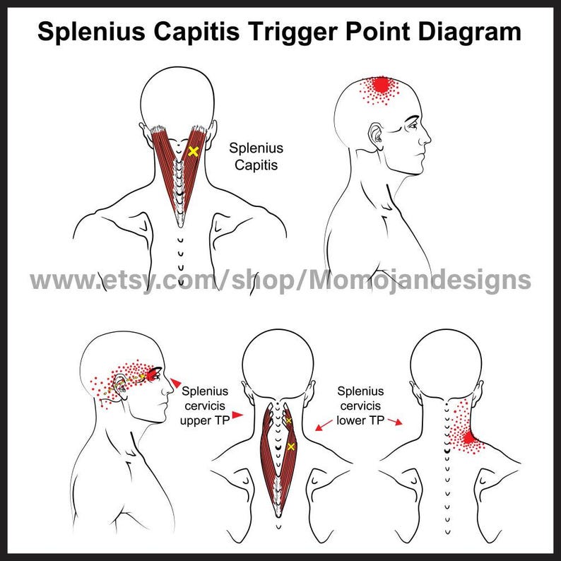 Head & Neck Trigger Point Charts: Muscle Pain Relief Diagrams (PDF) - Etsy