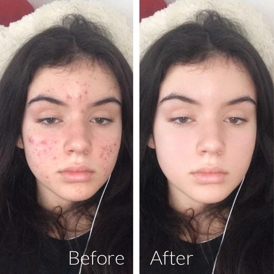 Skin Photo Retouch, Photoshop Skin Retouch, Remove Spots and Pimple ...