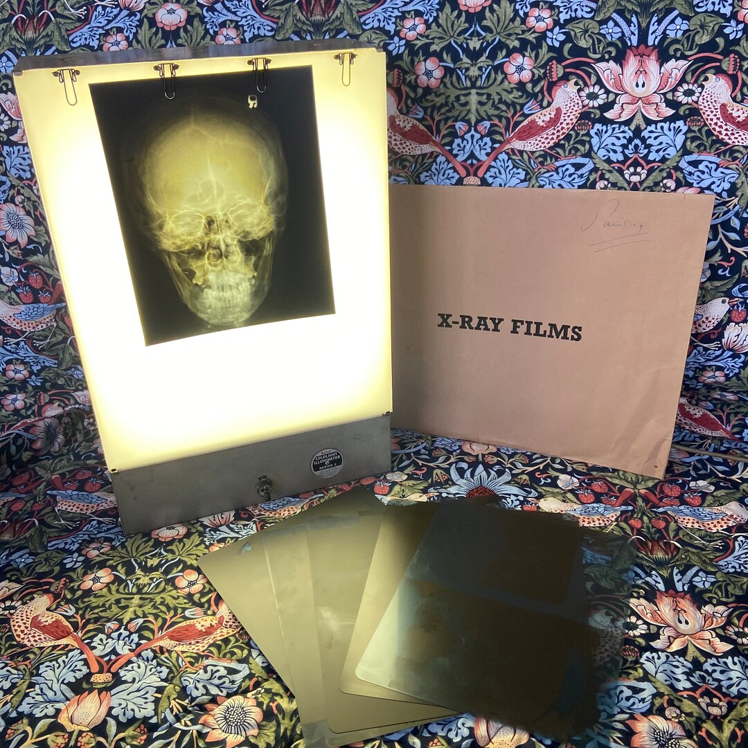 6x X-rays RARE ORIGINAL Hospital Medical X-rays Real Scientific Display ...