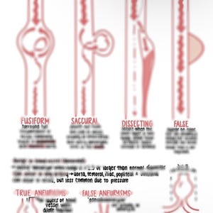 Aortic Aneurysms & Dissections: Comprehensive Nursing Notes on ...