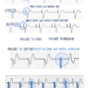 Pacing Perfection: Comprehensive Notes on Pacemakers, Rhythms ...