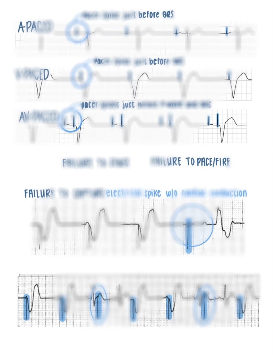 Pacing Perfection: Comprehensive Notes on Pacemakers, Rhythms ...