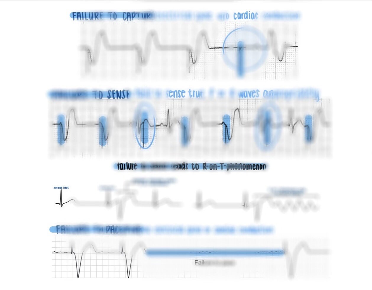 Pacing Perfection: Comprehensive Notes on Pacemakers, Rhythms ...