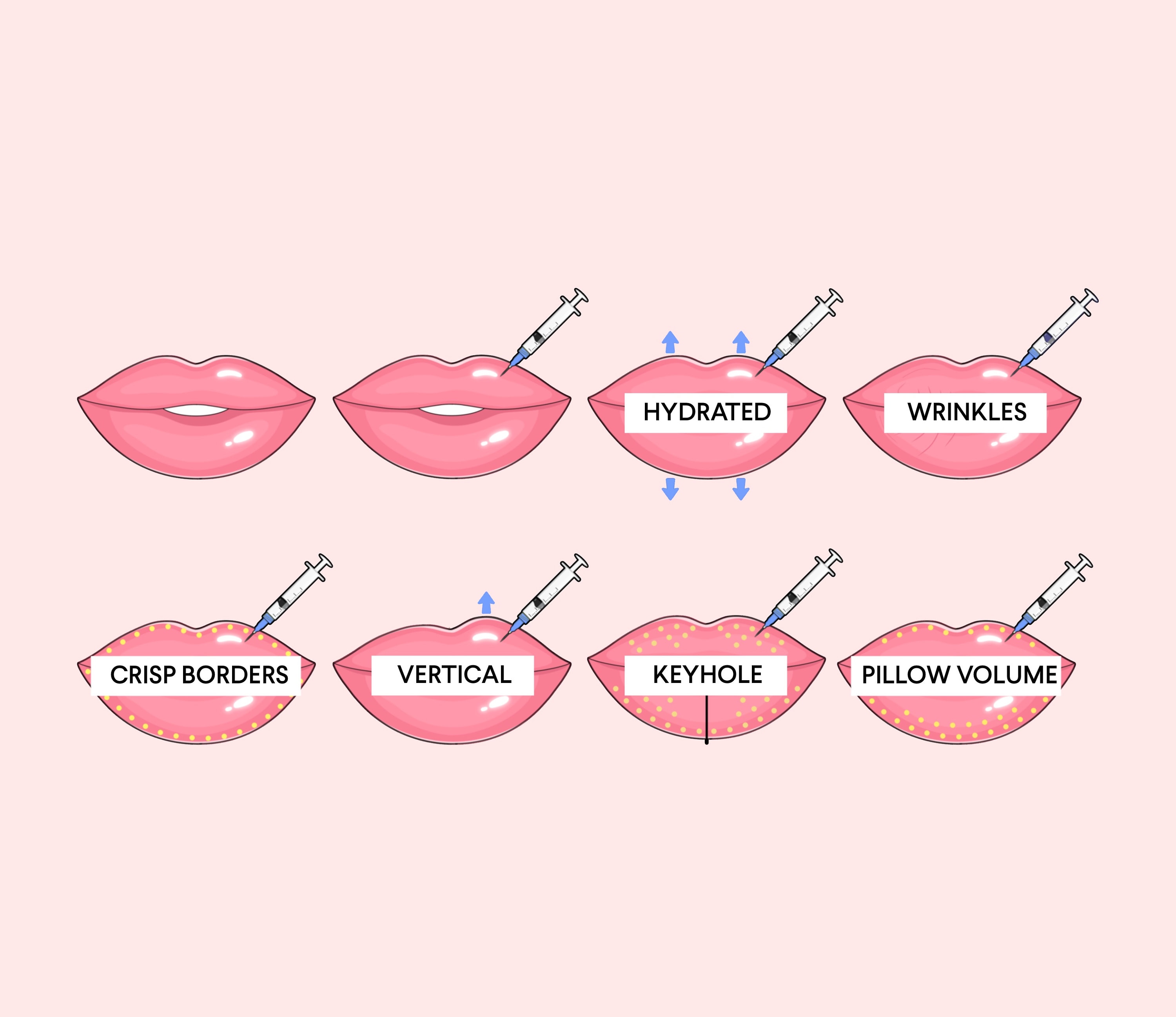 Lip Mapping Injections Clipart Pack Aesthetic Injector, Fillers ...