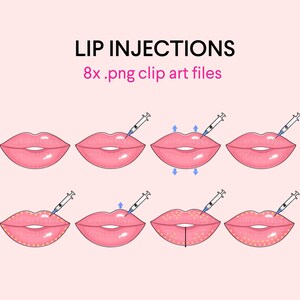 Lip Injection Mapping Clipart | Cosmetic Medspa Illustrations (PNG ...