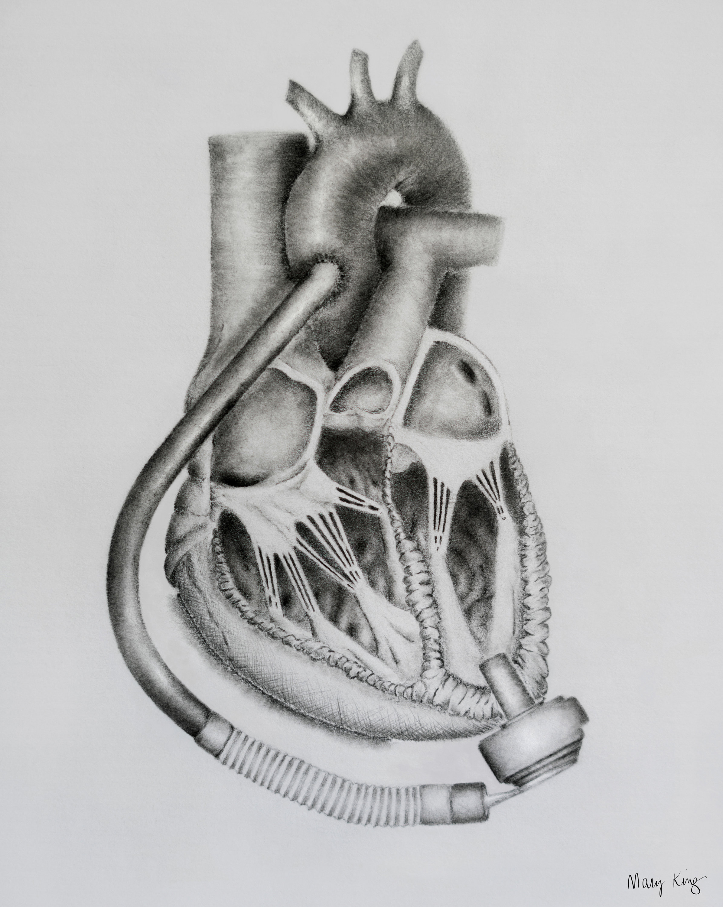 Heartmate 3 LVAD - Etsy