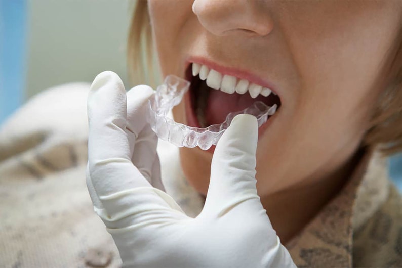 The Effectiveness of Occlusal Splints for Sleep Bruxism. Mouth Guards ...