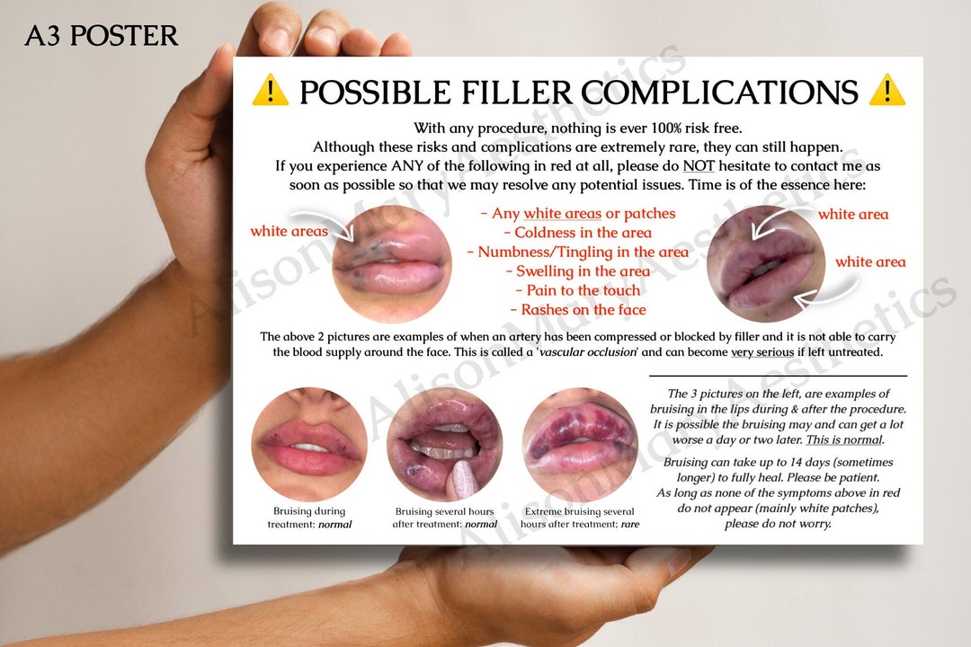 A3 POSTER Aesthetics Dermal & Lip Filler Complications Cards for ...