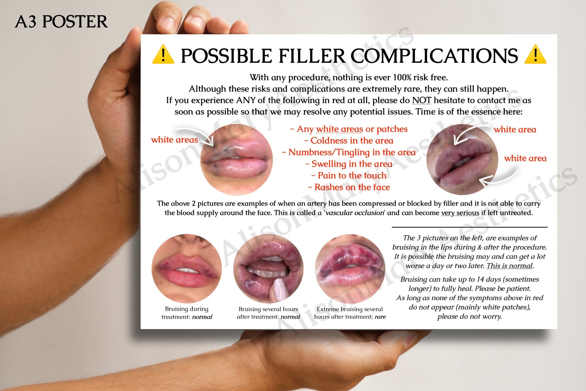 A3 POSTER Aesthetics Dermal & Lip Filler Complications Cards for ...
