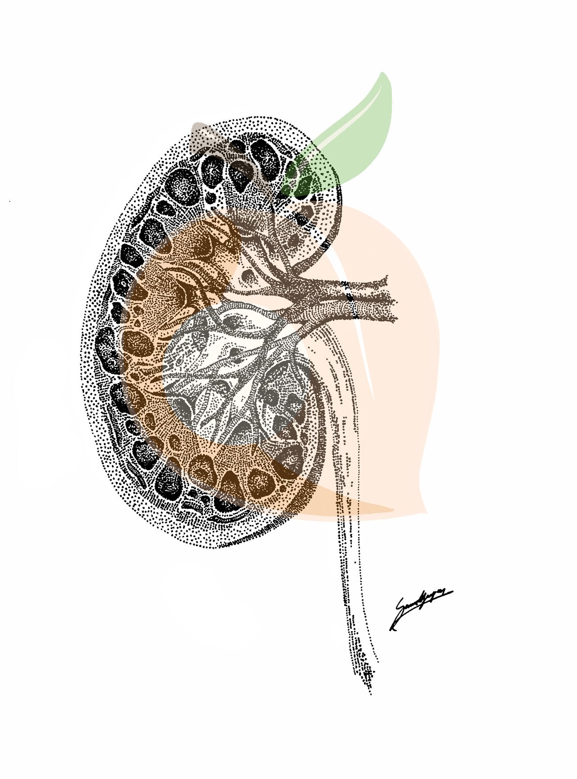 Kidney: Nephronophthisis (digital Download) - Etsy
