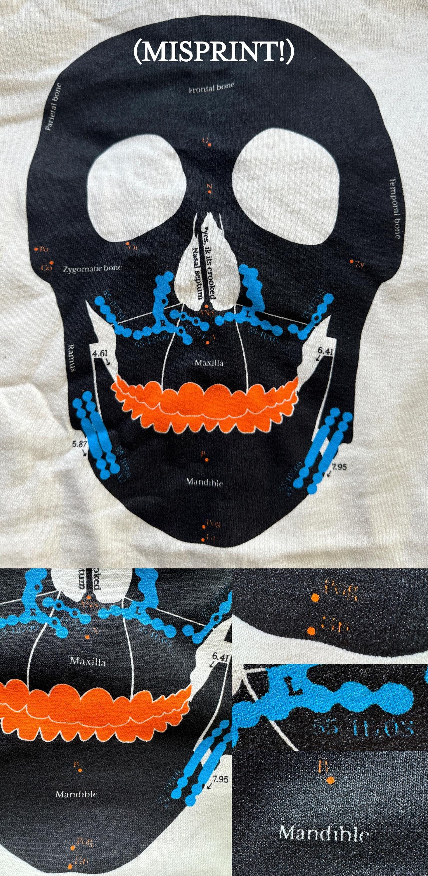 Orthognathic Jaw Surgery Tee – Lefort & BSSO, OMFS Gift (MISPRINT) - Etsy