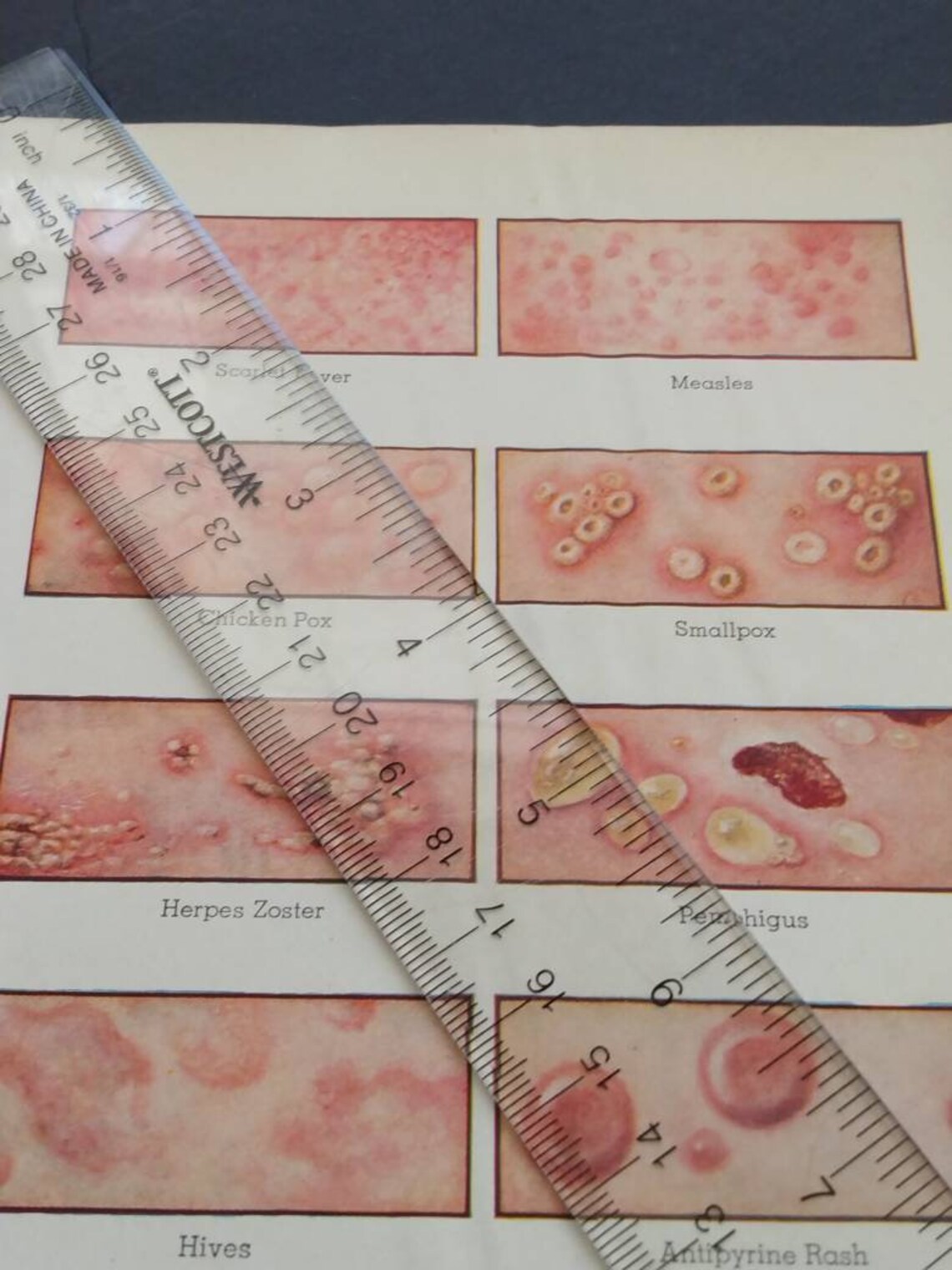 Skin Rash Measels Hives Plate Print Infection Medical Book Library ...