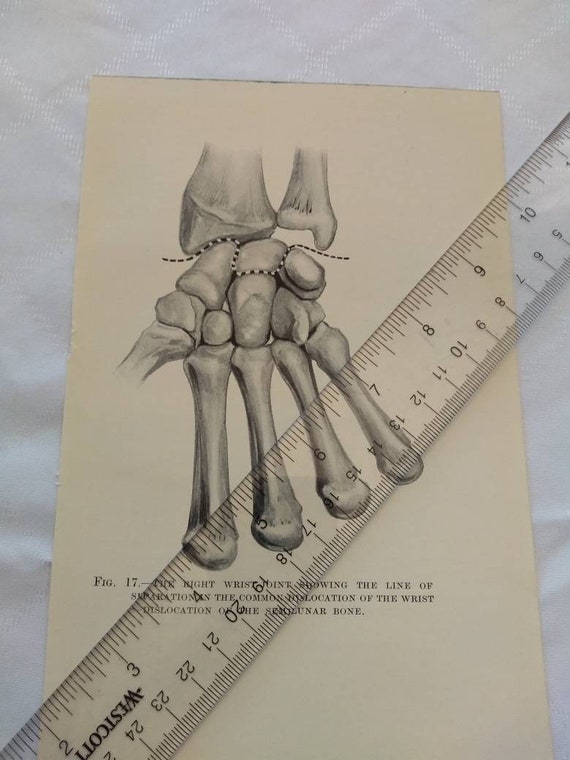 Wrist-joint Dislocation Semilunar Bone Vintage Medical - Etsy