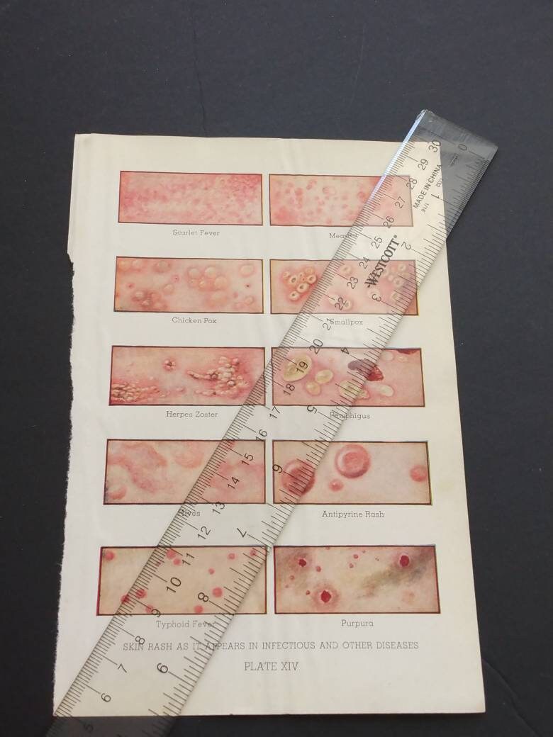 Skin Rash Measels Hives Plate Print Infection Medical Book Library ...