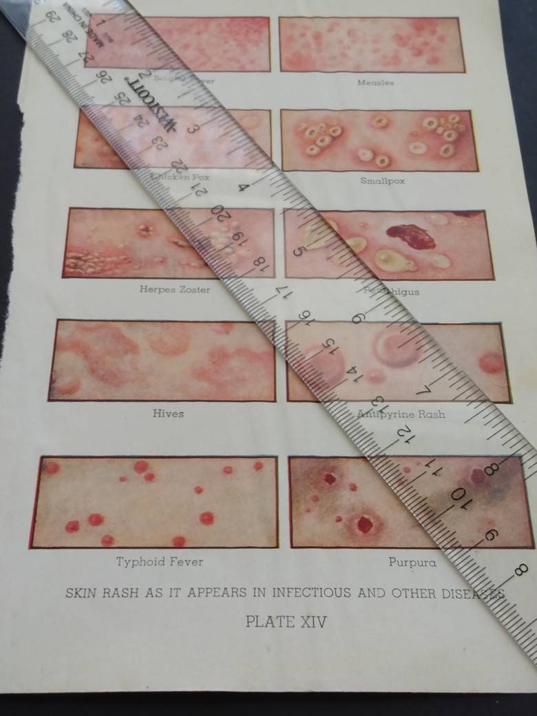 Skin Rash Measels Hives Plate Print Infection Medical Book Library ...
