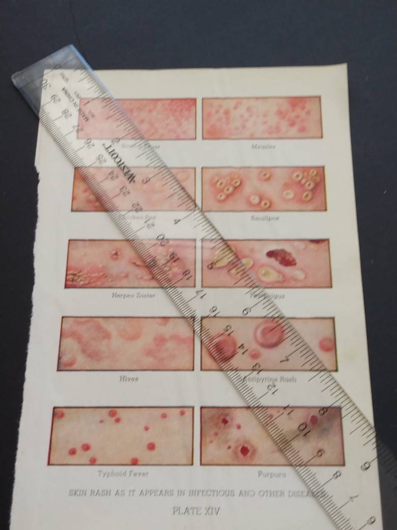 Skin Rash Measels Hives Plate Print Infection Medical Book Library ...