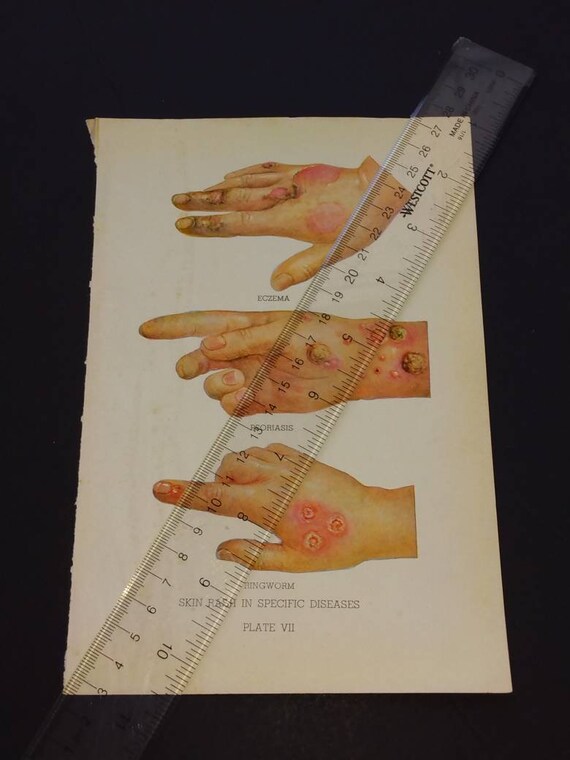 Skin Rash in Specific Disease Print Infection Medical Book - Etsy