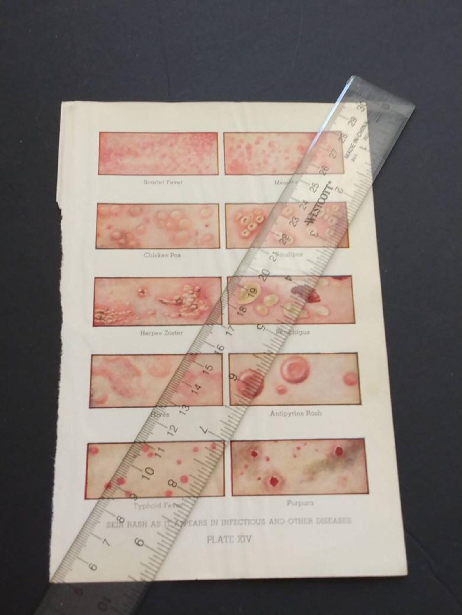 Skin Rash Measels Hives Plate Print Infection Medical Book Library ...