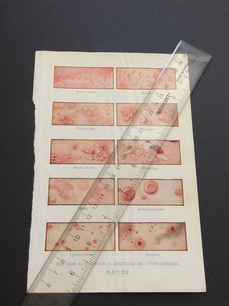 Skin Rash Measels Hives Plate Print Infection Medical Book Library ...