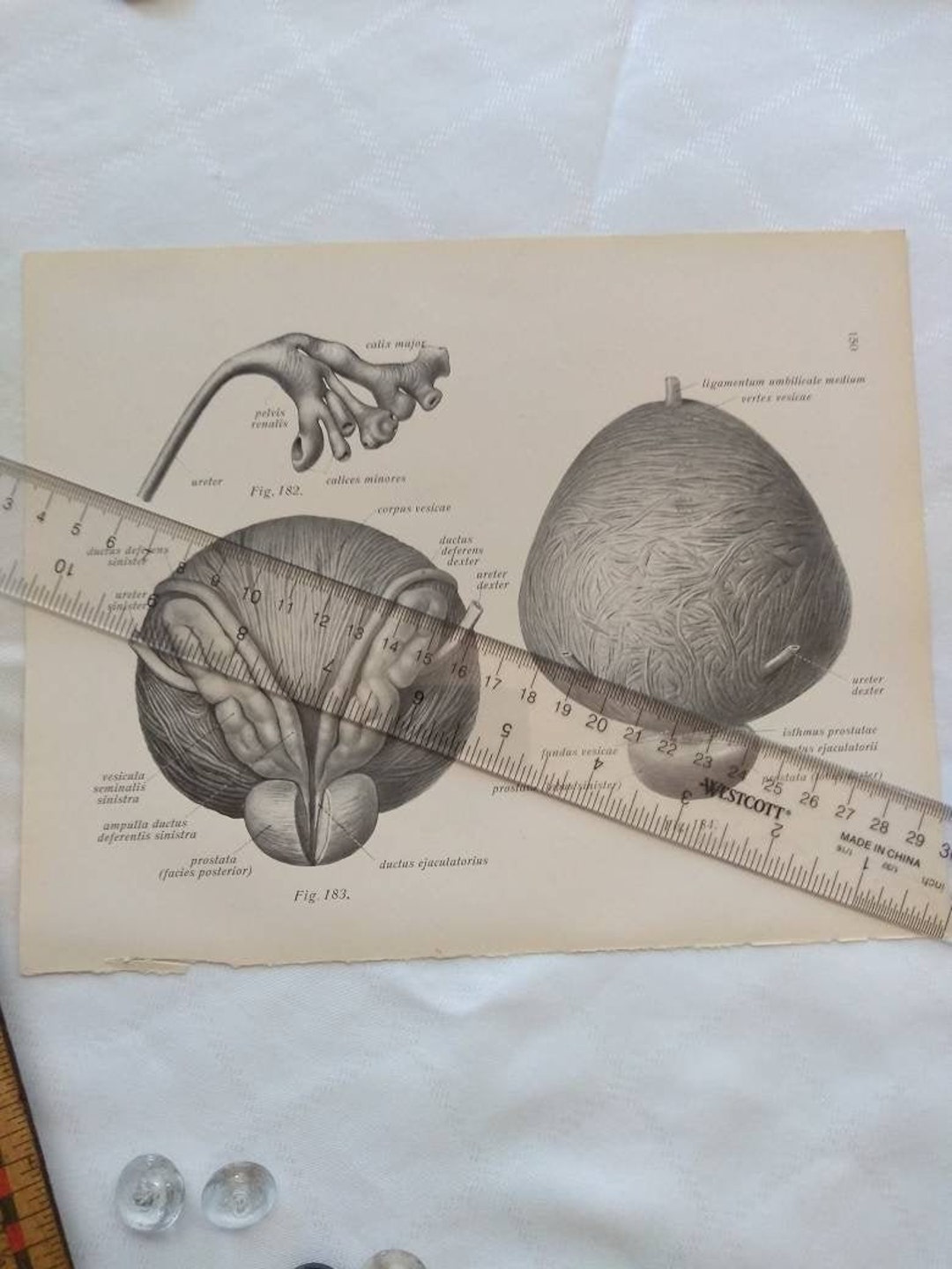 Bladder Urinary Track Prostate Diagram Dissection Anatomy Drawing ...