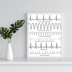 EKG Poster for Cardiologist Office Sign for Abnormal Heart Rhythm VFIB ...