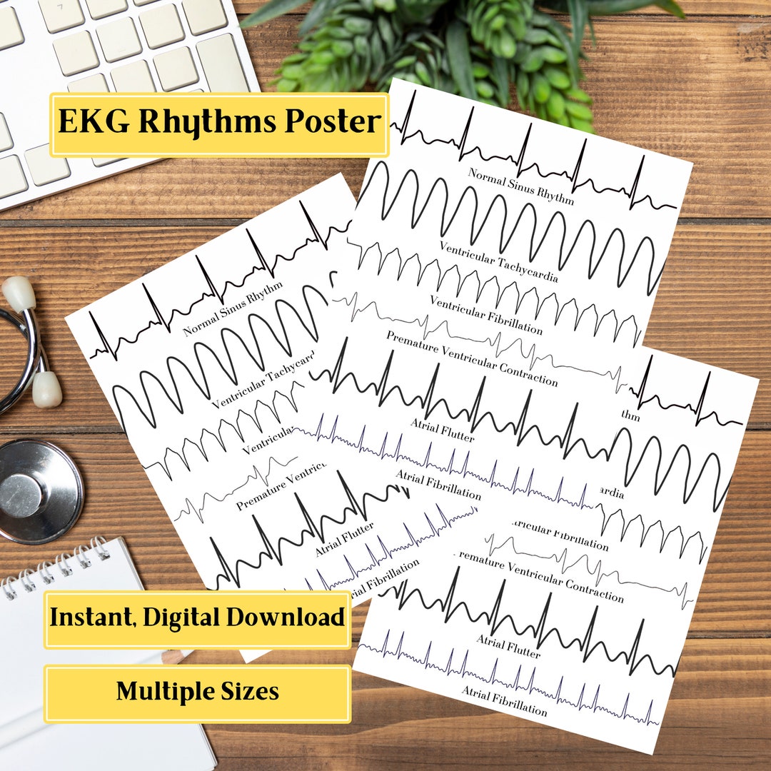 EKG Poster for Cardiologist Office Sign for Abnormal Heart Rhythm VFIB Patients Tachycardia AFIB ...