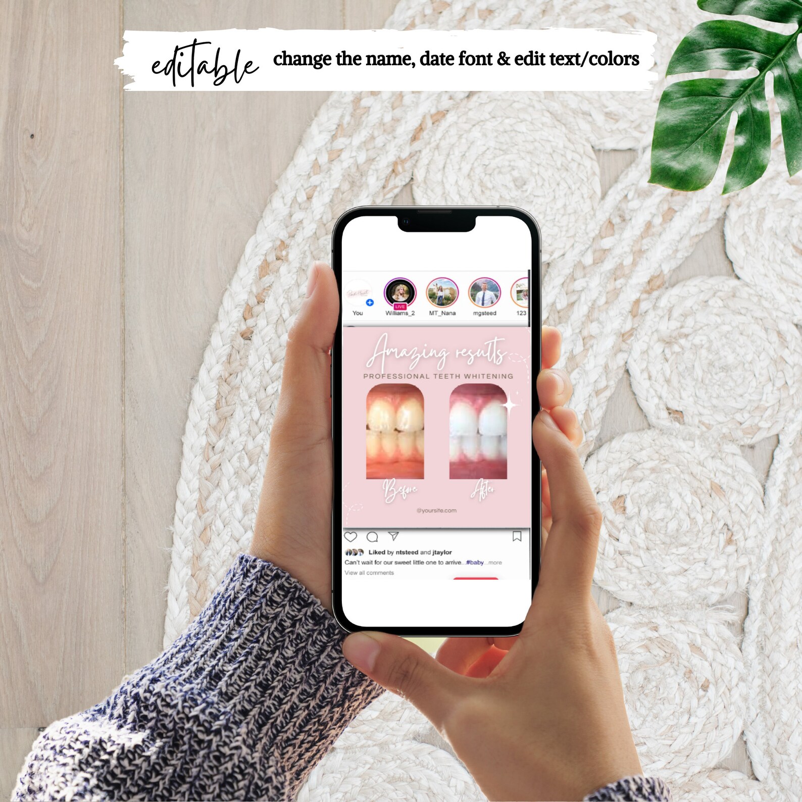 50 Teeth Whitening Instagram Post Templates, Editable Teeth Whitening ...