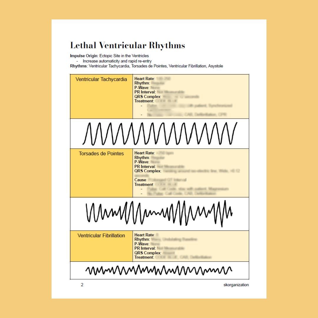 Ventricular Rhythms | ECG Basics | ECG Interpretation | Cheat Sheet ...