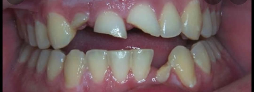 Chip Miss or Cricket Teeth Restoration - Etsy UK