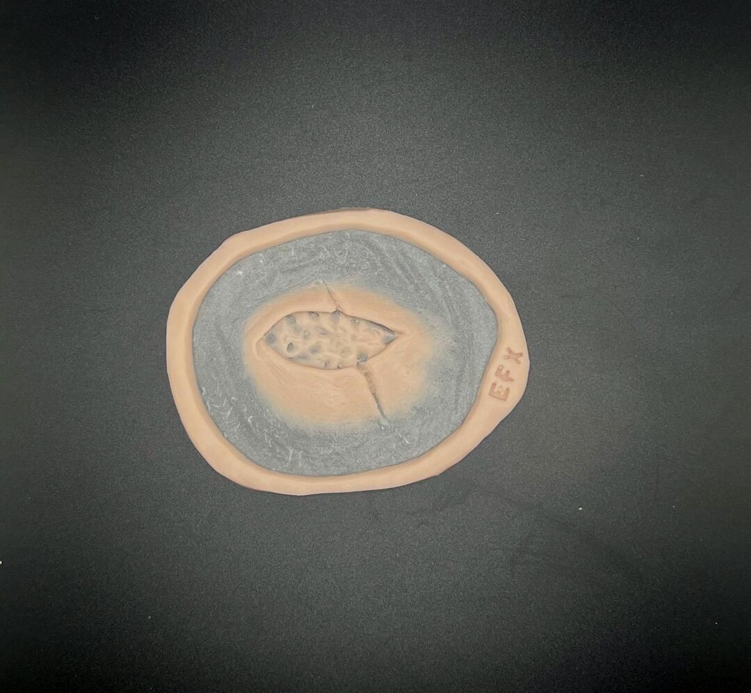 Ripped Out Eye (LEFT) Encapsulated Prosthetic, Swollen Eye, Gore ...