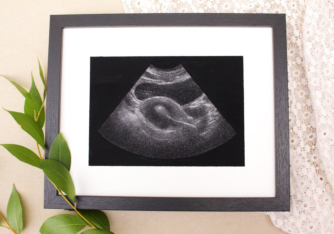 Custom Embryo Transfer Ultrasound Art or Sonogram Art | Pregnancy ...