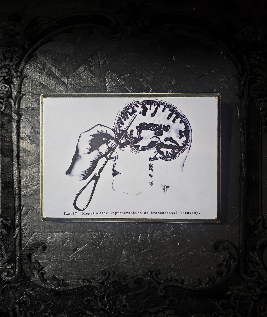 Vintage Lobotomy Poster Wall Plaque - Etsy