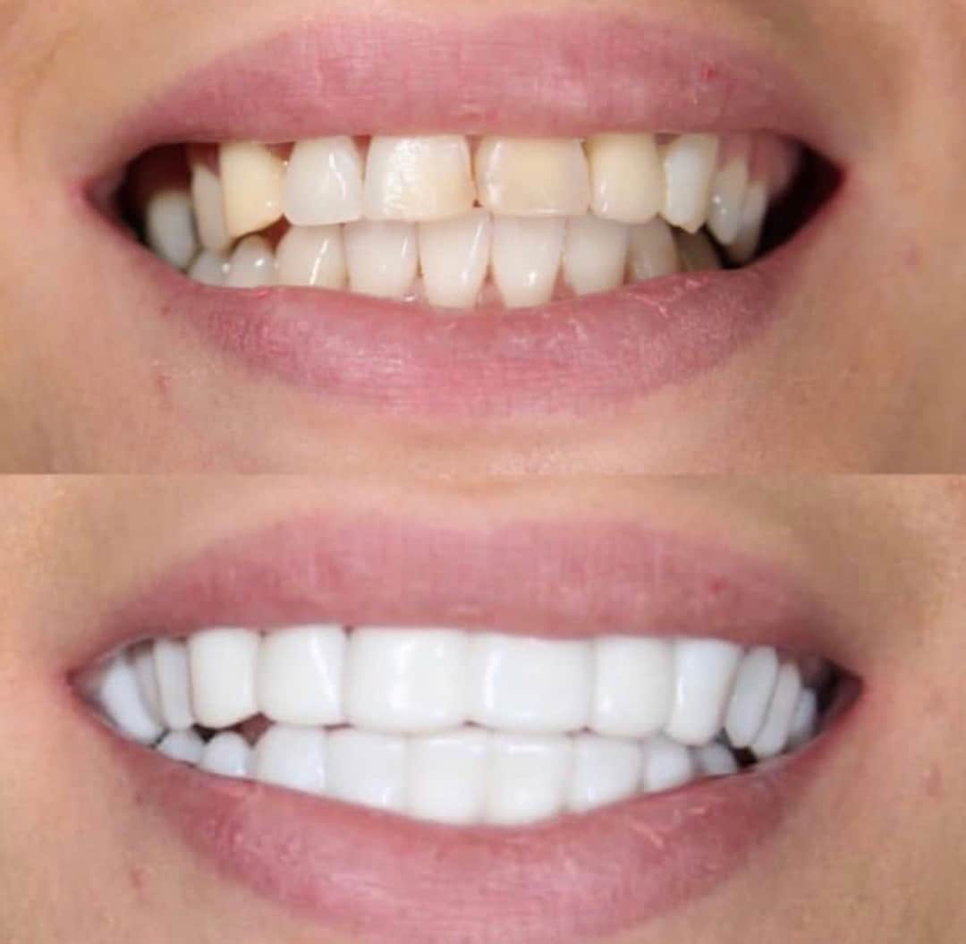 Snap on Veneers Removable Veneers - Etsy