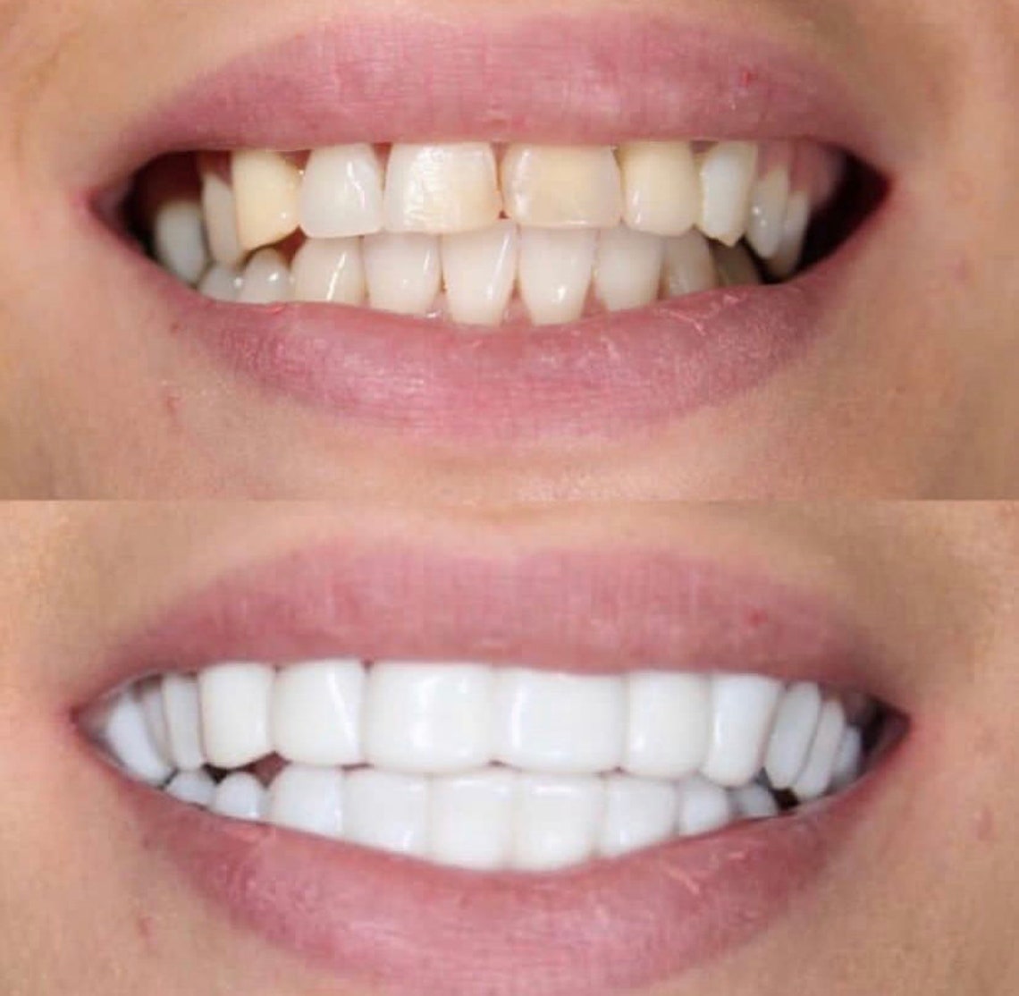 Snap on Veneers Removable Veneers - Etsy