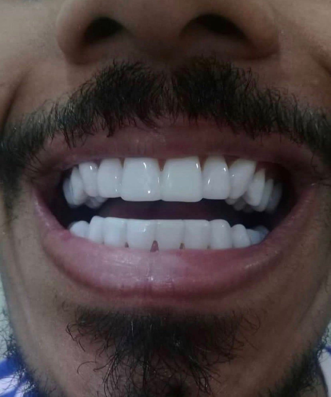 Snap on Veneers Removable Veneers - Etsy